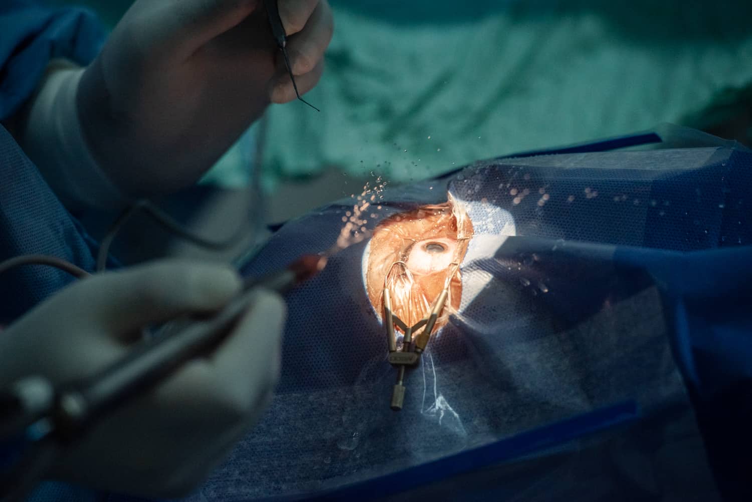 FEATURE: Free cataract surgeries changing lives in Mpumalanga town ...